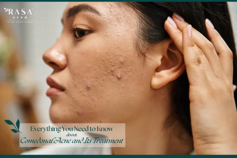 Everything You Need To Know About Comedonal Acne And Its Treatment ...